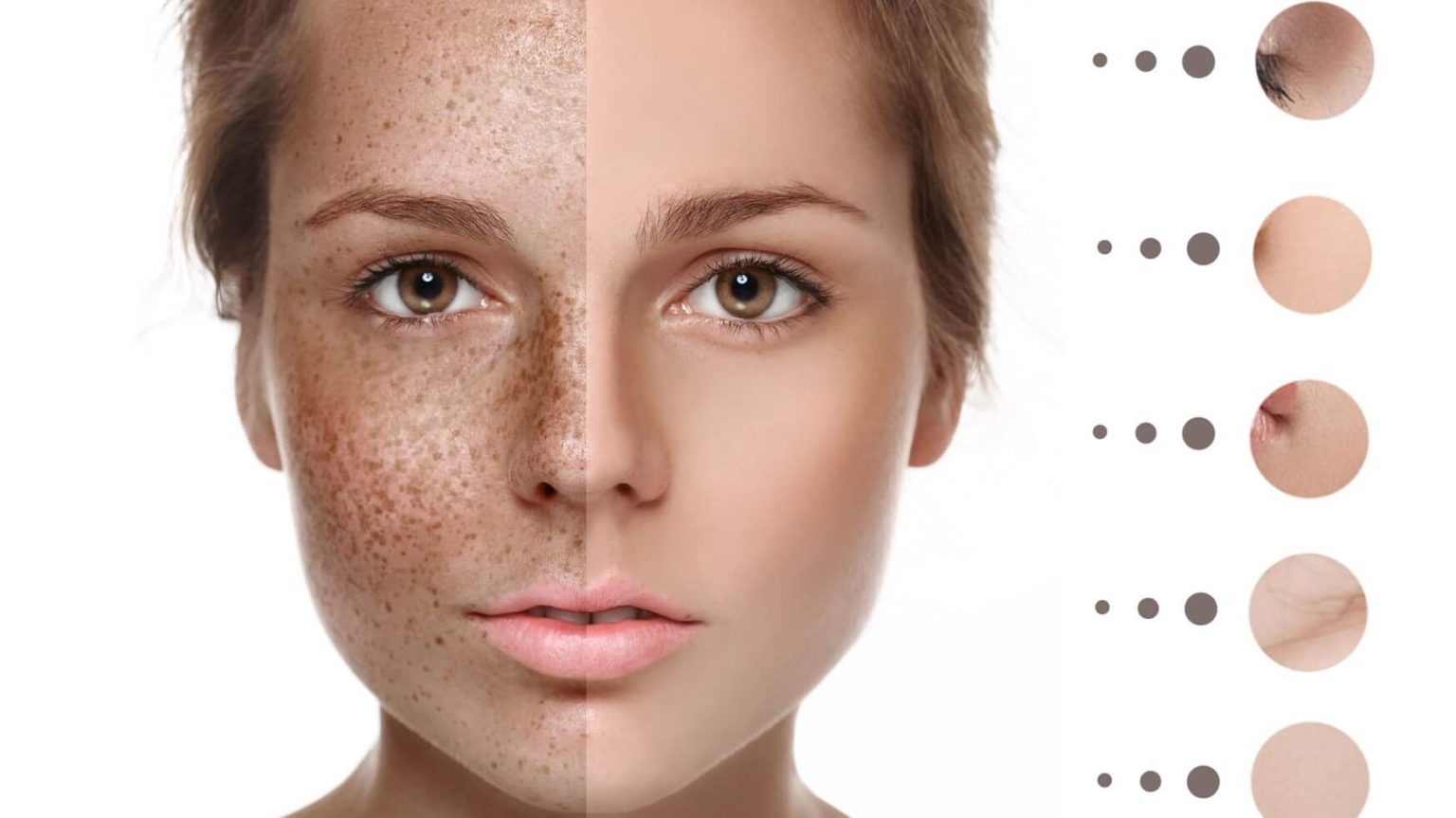 Pigmentation on Face - Causes, Types and Treatment: Beauty Tips By Nim